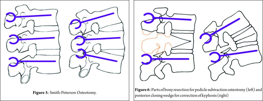 Positive Sagittal Balance and Management Strategies in Adult Spinal ...