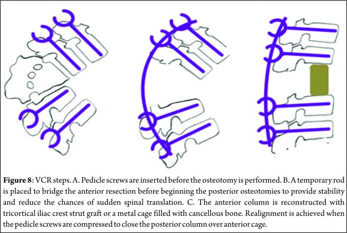Positive Sagittal Balance and Management Strategies in Adult Spinal ...