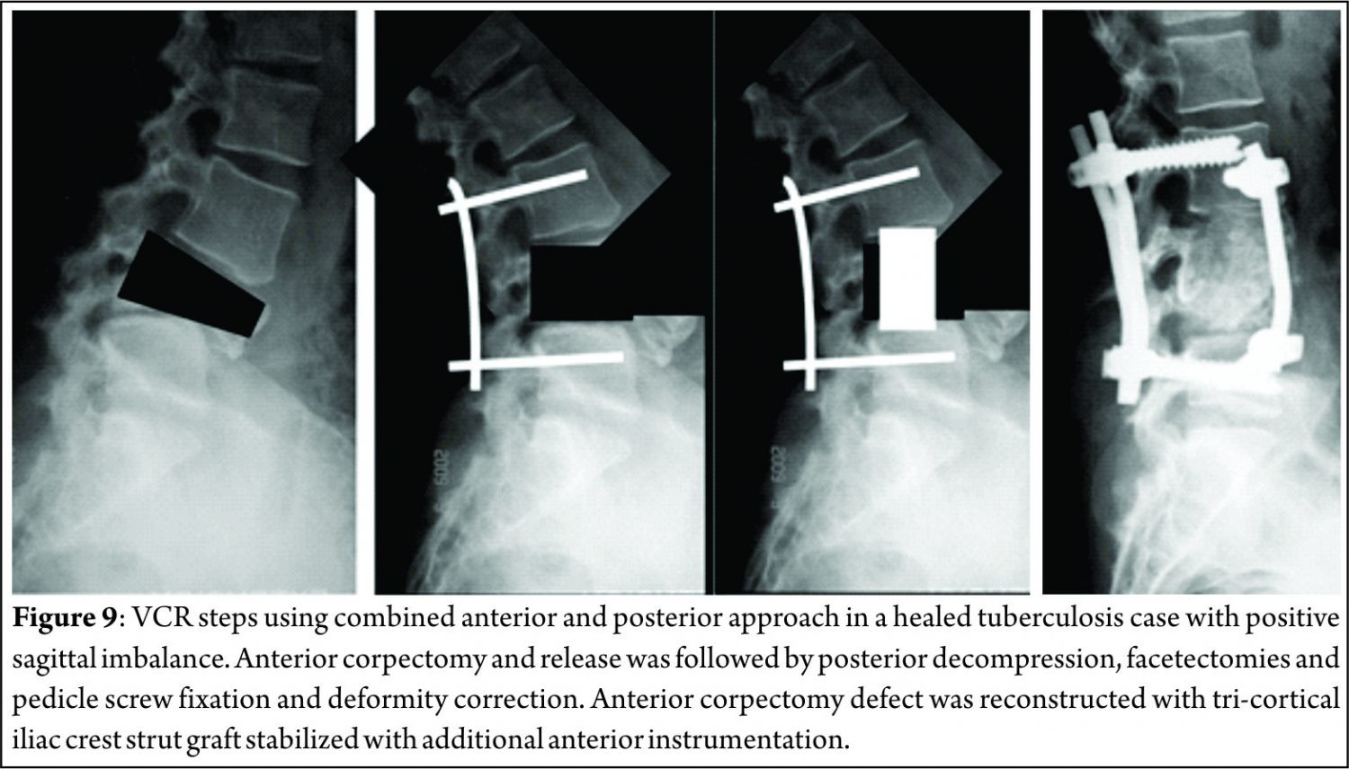 Positive Sagittal Balance and Management Strategies in Adult Spinal ...