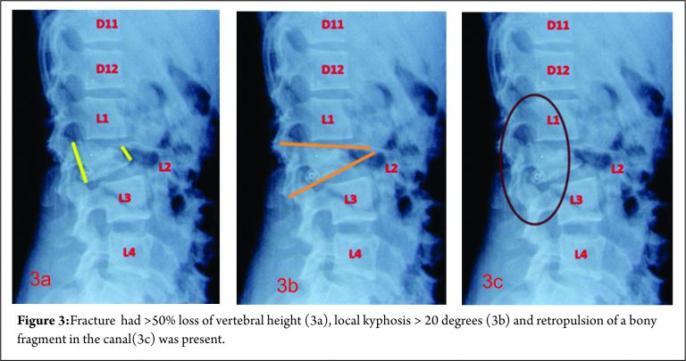 Treatment Algorithm For Unstable Burst Fracture – International Journal ...