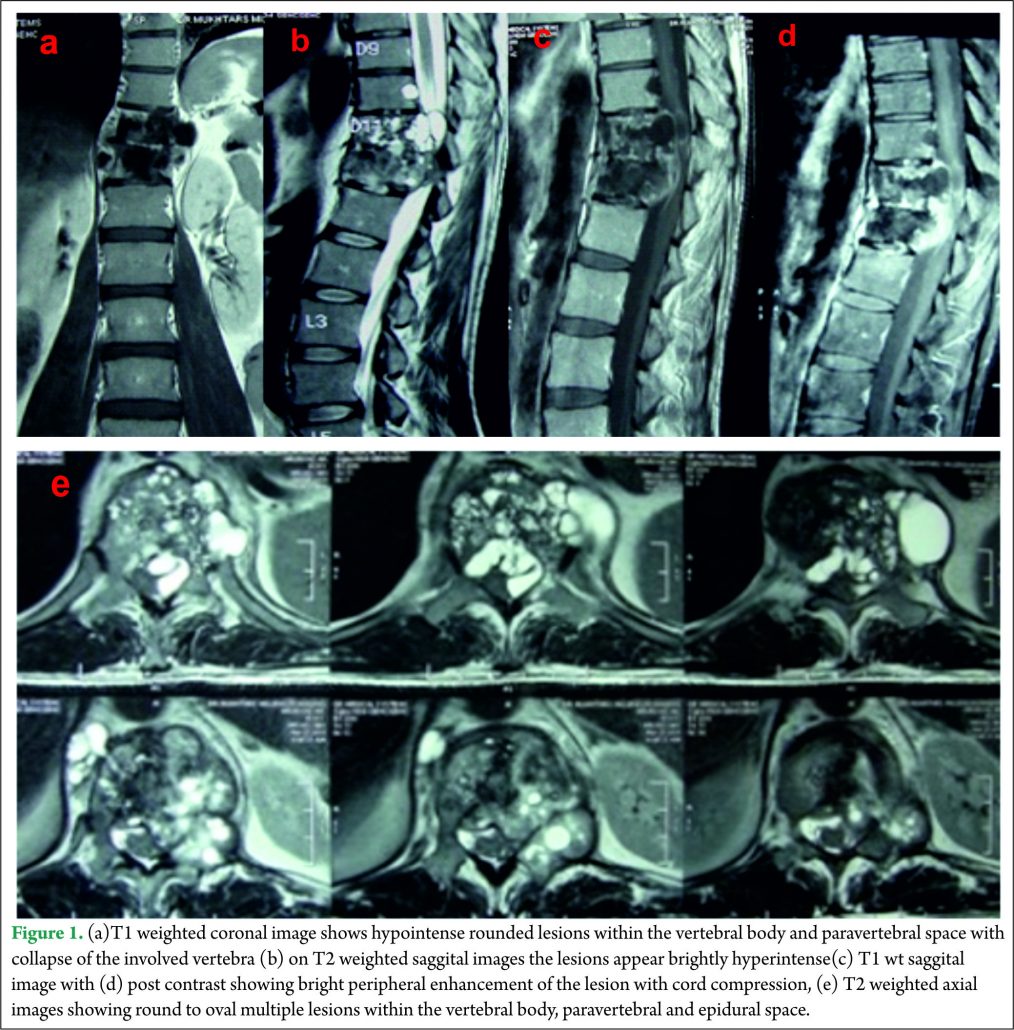 Primary disseminated Hydatid disease of the vertebral body and ...